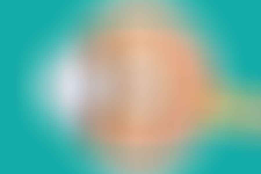 What is Exotropia? How Common is it?