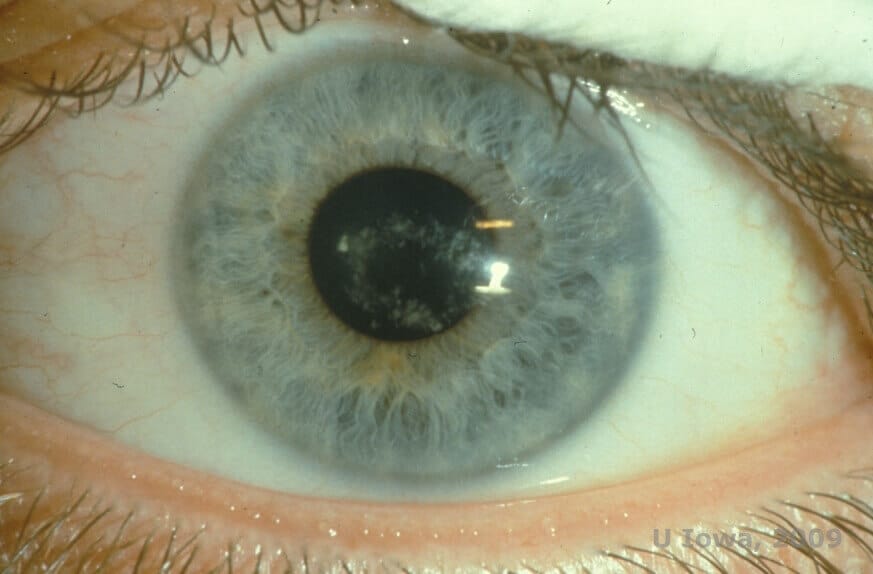Understanding Fuchs' Dystrophy: How Scleral Lenses Can Help