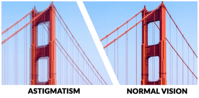 Understanding Astigmatism Types Symptoms Causes And Treatments