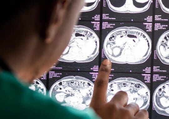 Understanding Visual Snow Syndrome: Evaluation and Treatment Options ...