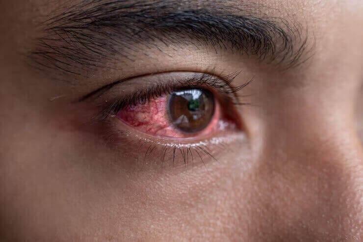 Chemical Eye Injuries from Acids - Specialty Vision