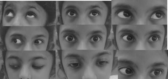 Duane Syndrome and Vision