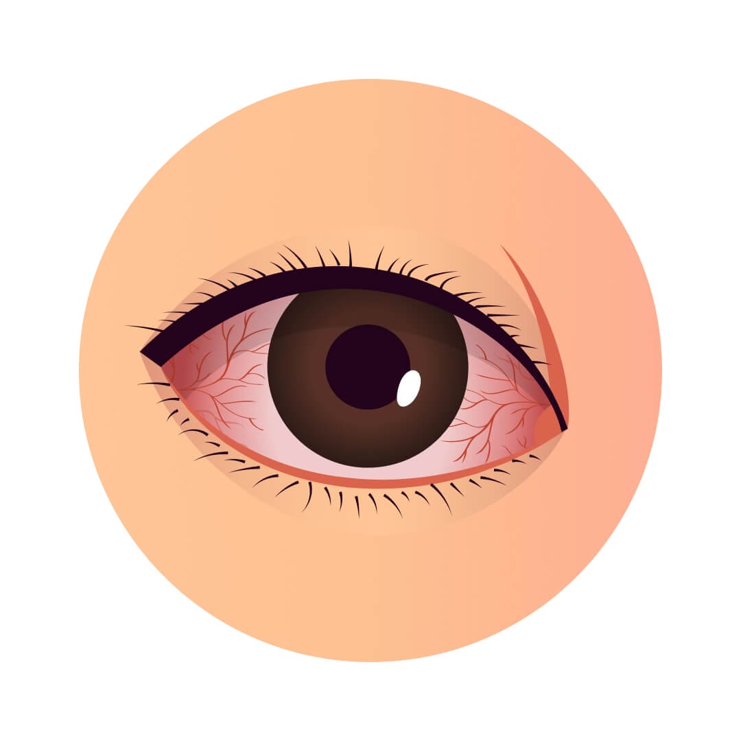 Comprehensive Guide to Eye Infections - Symptoms and Treatments ...