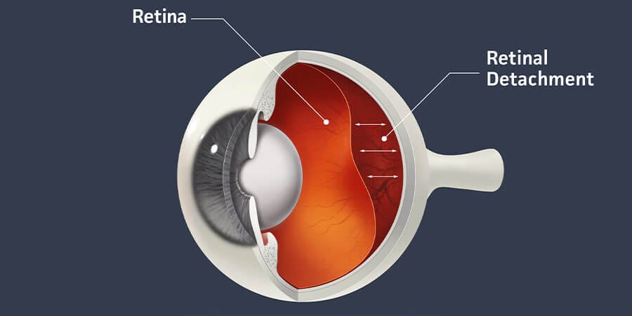 Pneumatic Retinopexy: Effective Treatment for Retinal Detachment ...